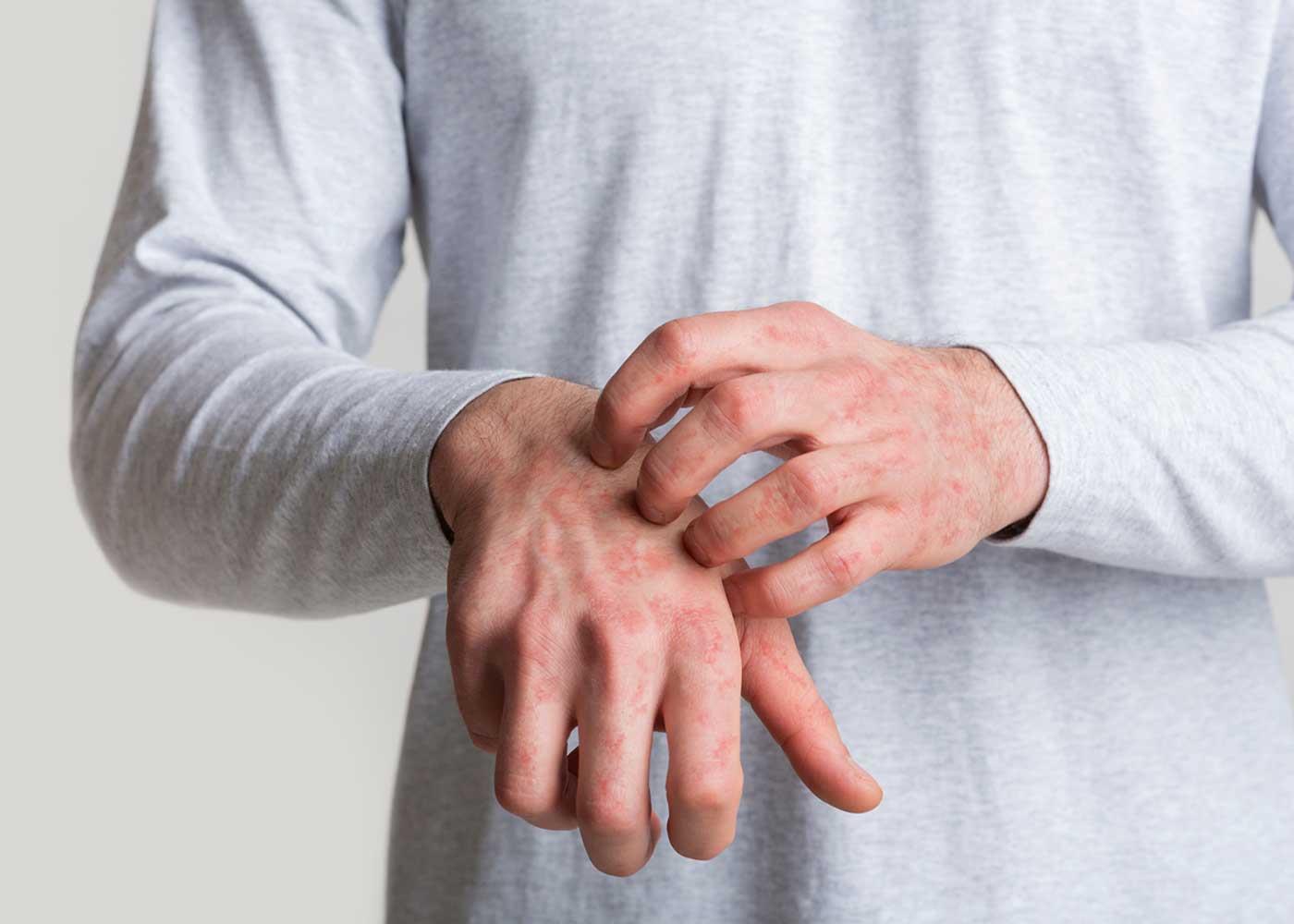 Borite se sa Ekcemom Na Rukama?